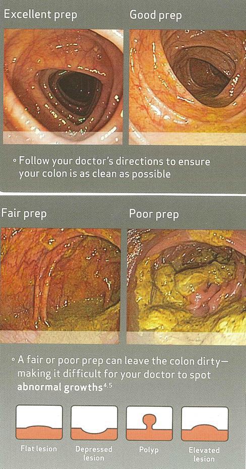 Can a colonoscopy be done without a prep?
