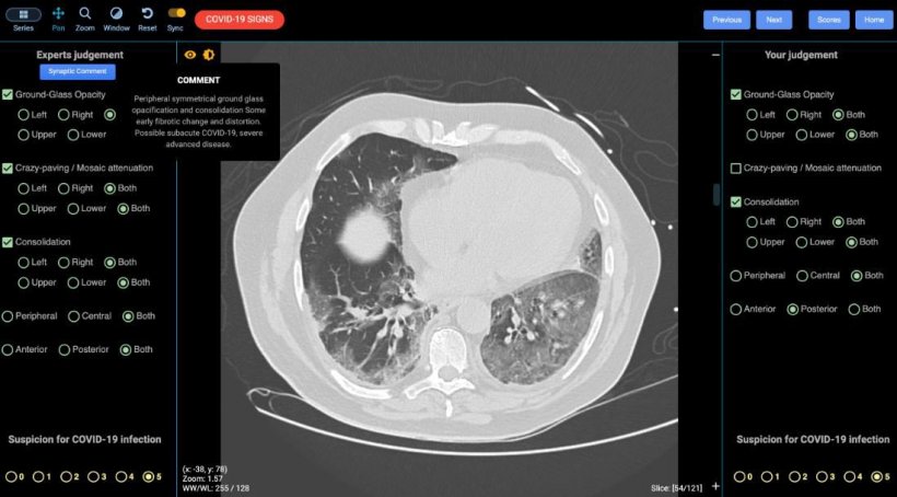 Can COVID-19 be detected by CT scan?
