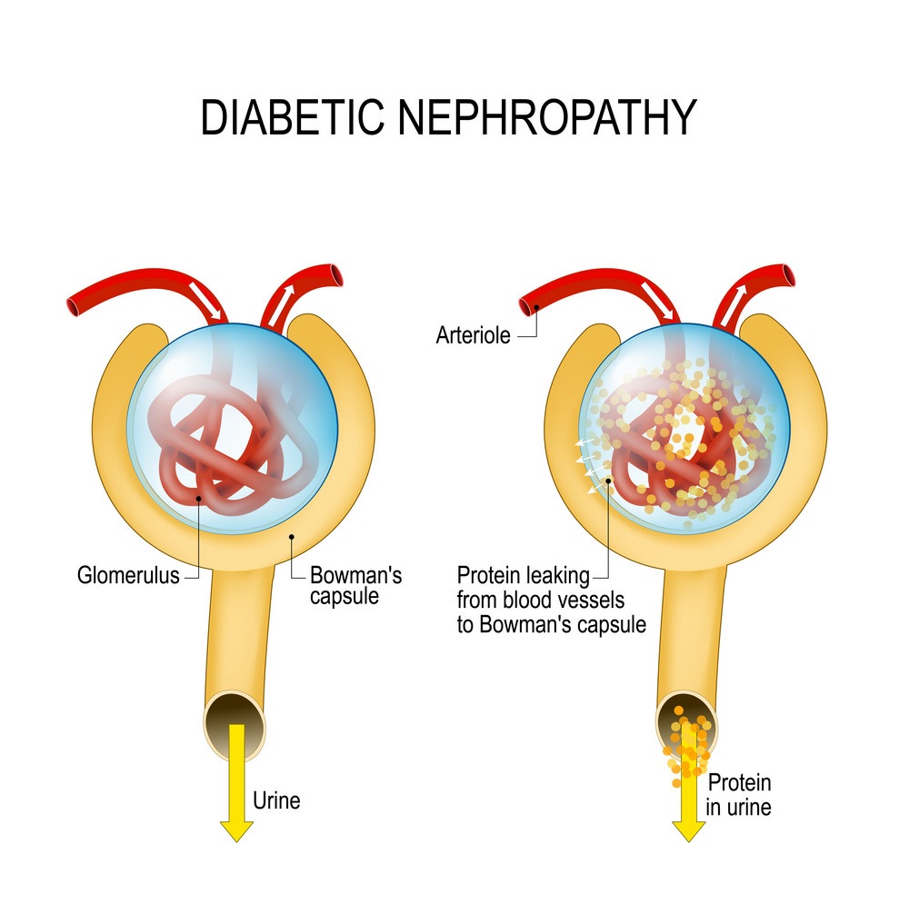 Can diabetic nephropathy be stopped?