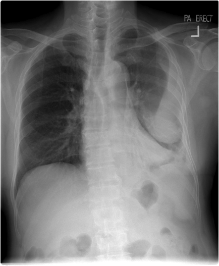 Can fish bones enter lungs?