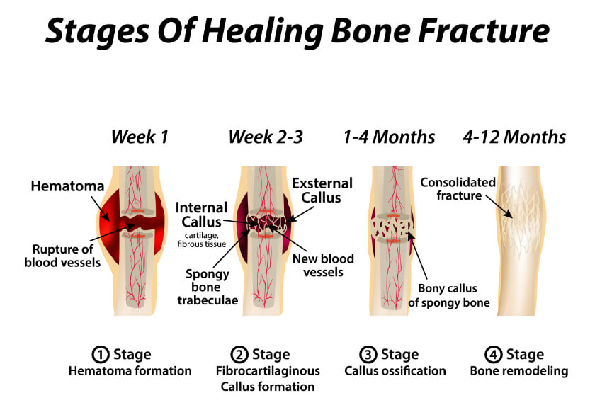 Do broken bones ever fully heal?