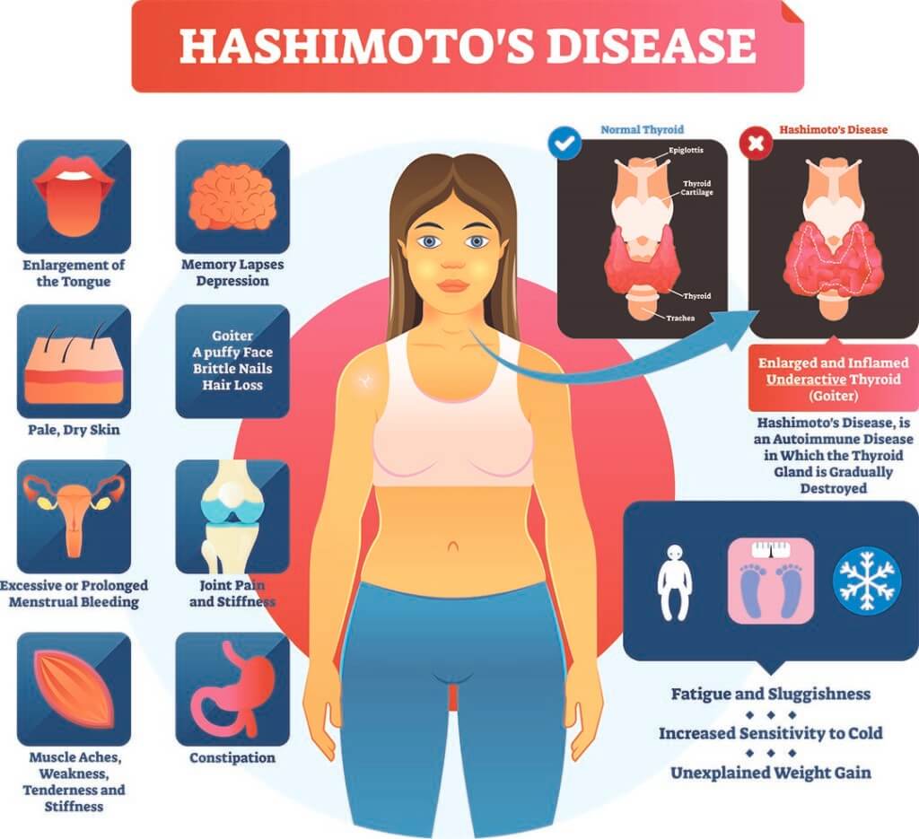 Does Hashimoto's cause inflammation in the body?