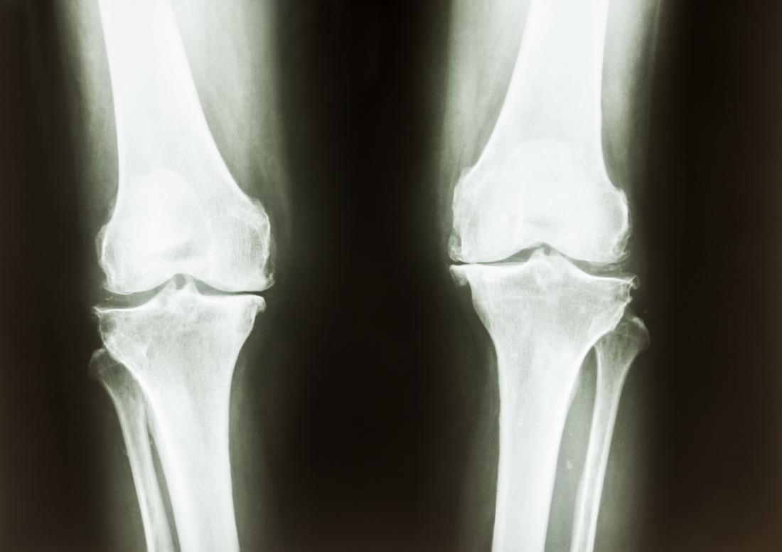 Does soy strengthen bones?