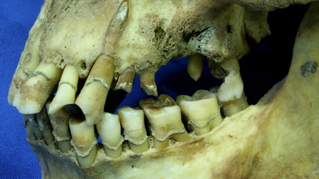 How did the Irish Potato Famine affect the teeth of victims?