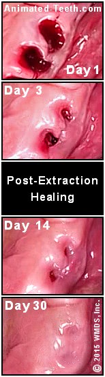 How do I know if my tooth extraction is healing properly?