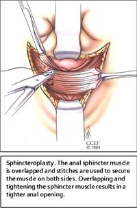 How do you fix bowel leakage?