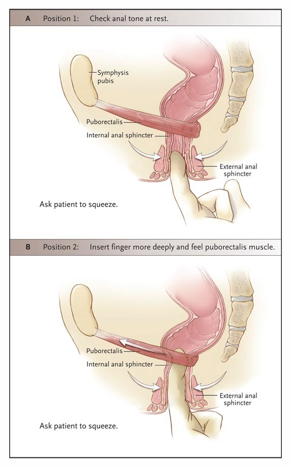 How do you live with bowel incontinence?