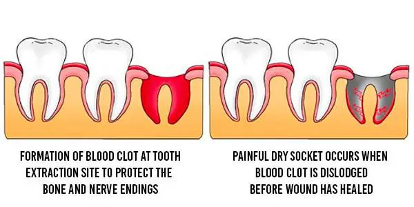 How long does it take for a tooth extraction to heal?