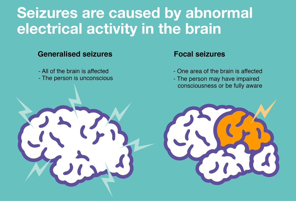 How long does unconsciousness last after seizure?