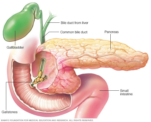 Is an inflamed pancreas serious?