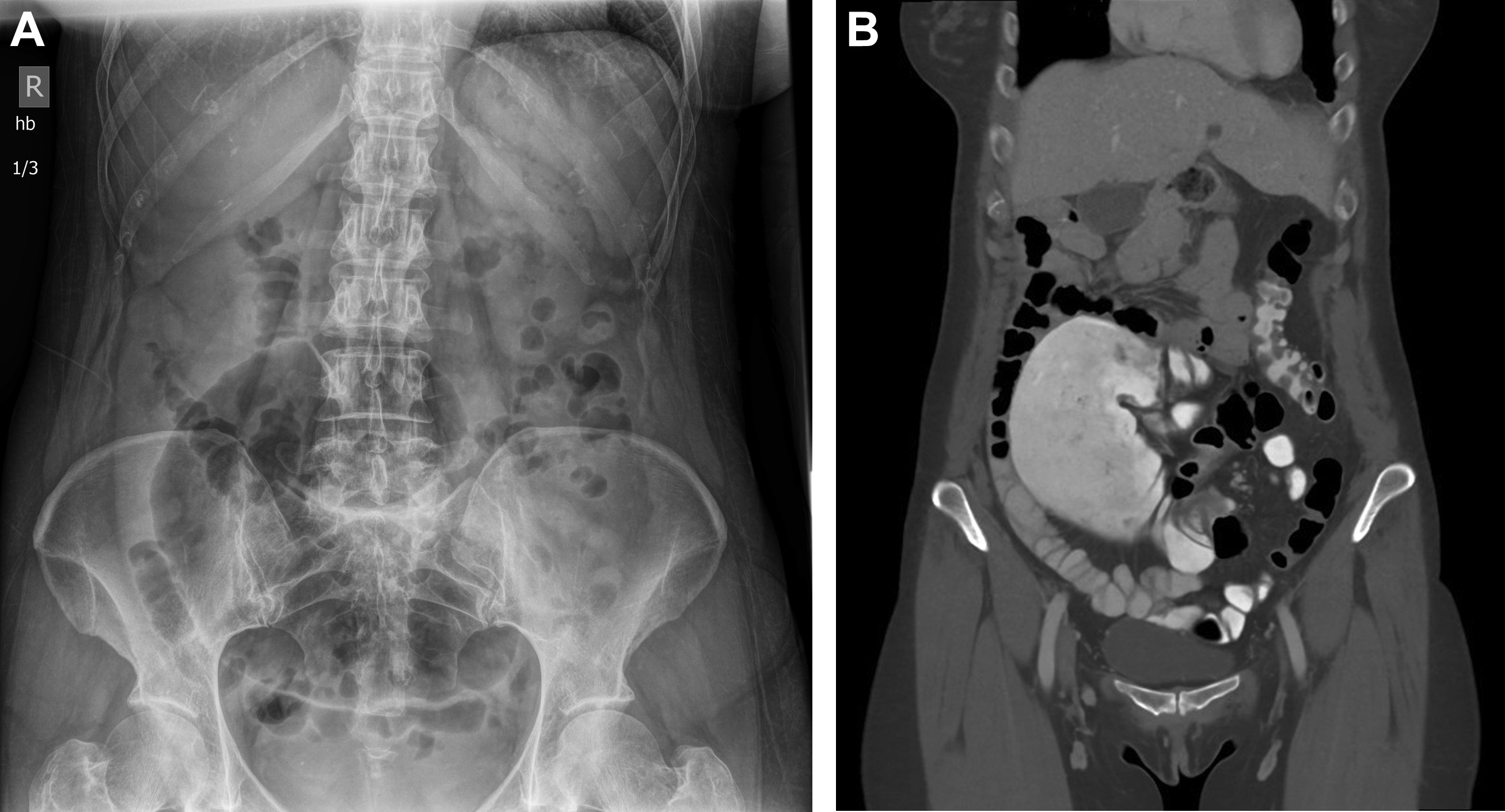 Is it normal to have stomach pain the day after a colonoscopy?