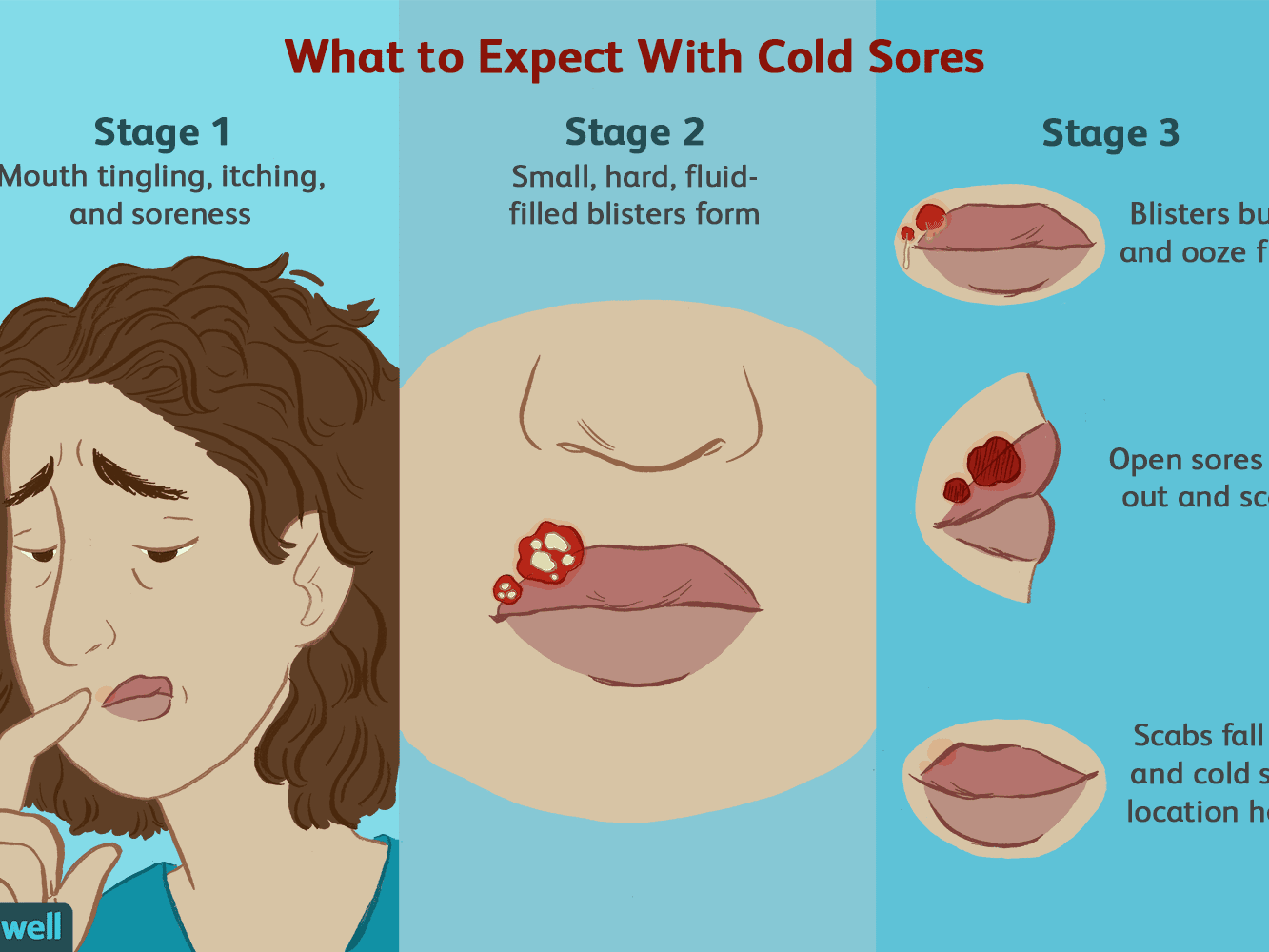 What can make a cold sore worse?