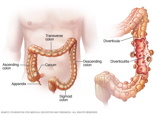 What causes diverticulitis?