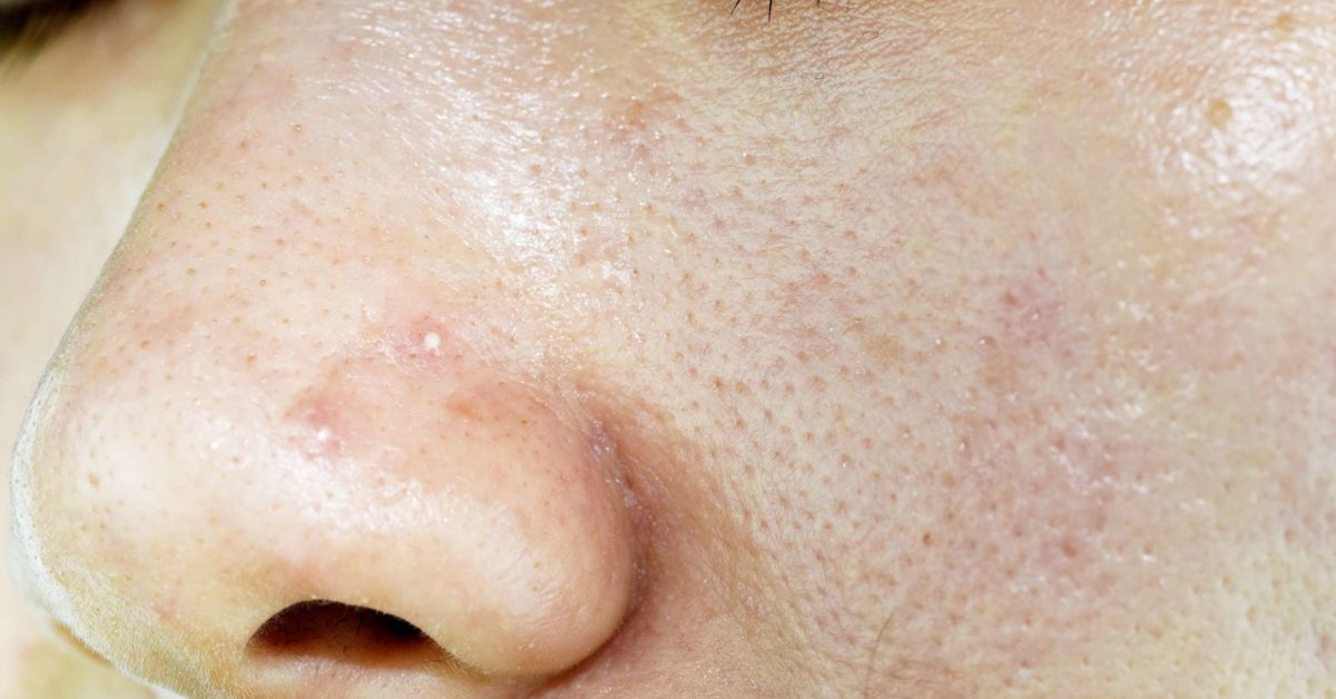 What causes your skin to be oily?