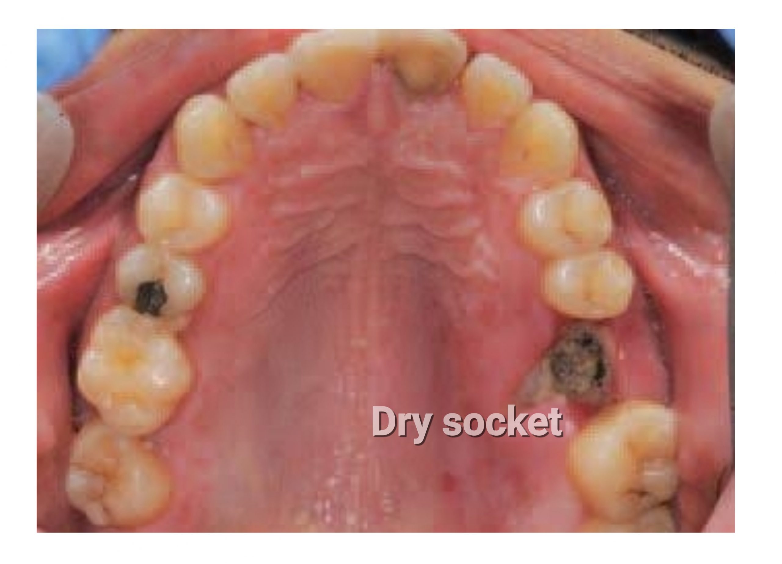 What Colour should a tooth extraction site be?