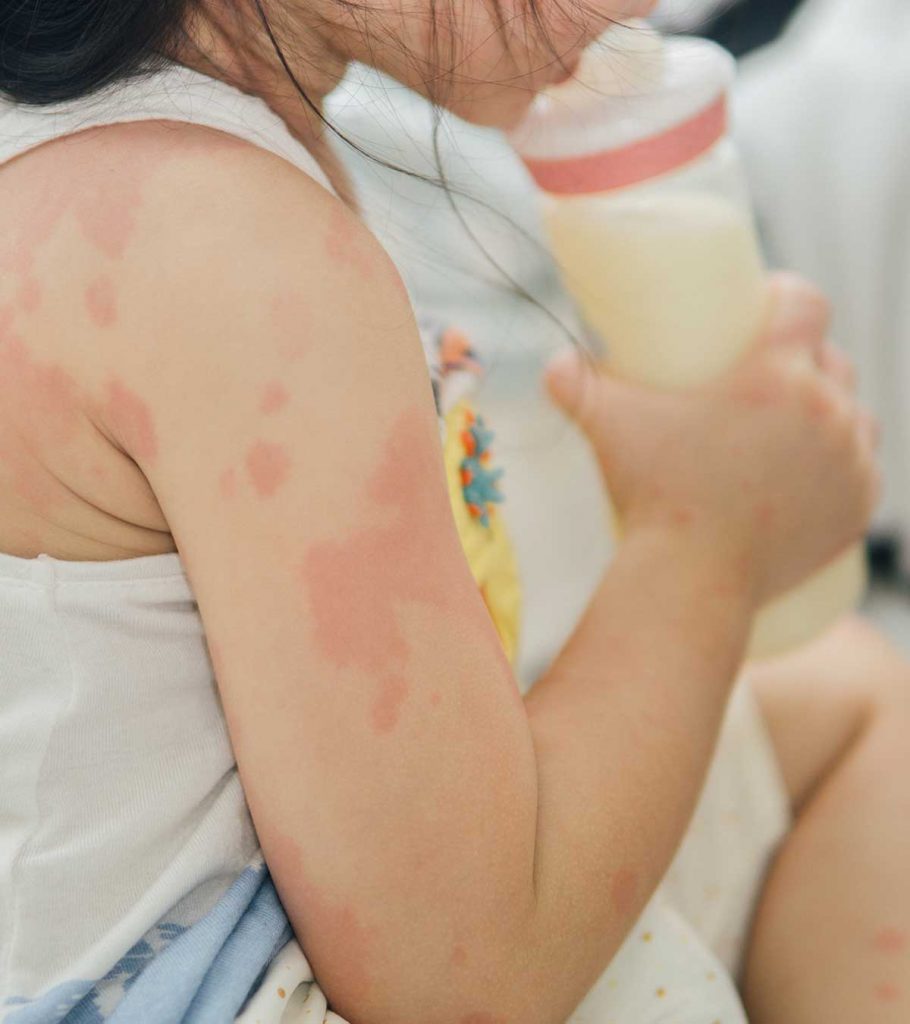What does a dairy allergy look like?