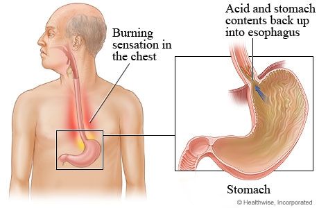 What does a sour stomach indicate?