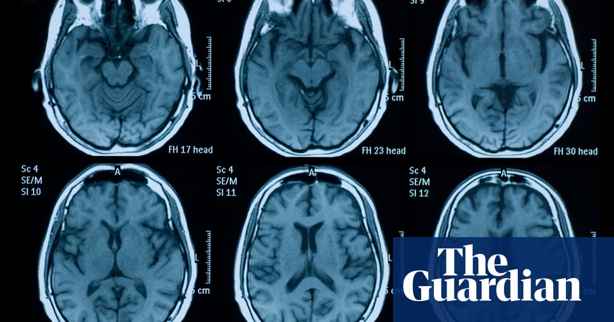 What foods shrink your brain?