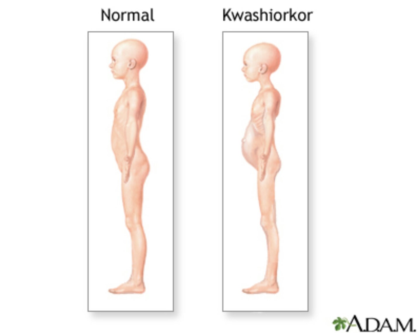 What happens if we don't eat protein?