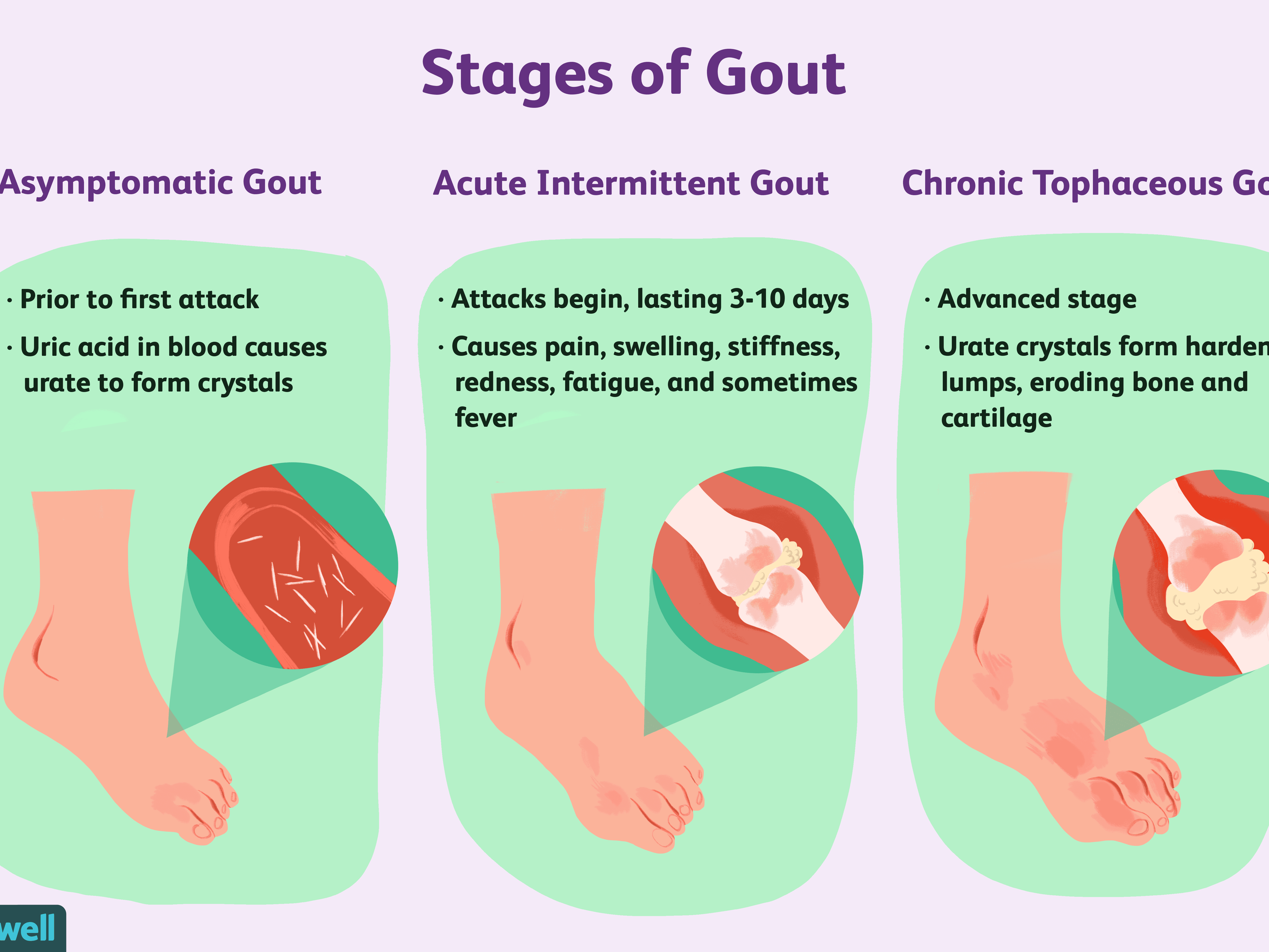 What happens to uric acid in gout?