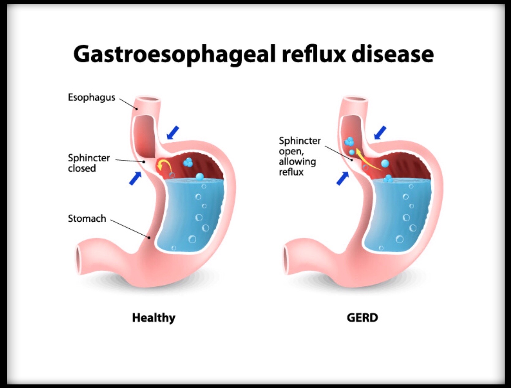 What happens to your stomach as you age?