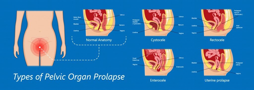 What is queefing or vaginal farting?